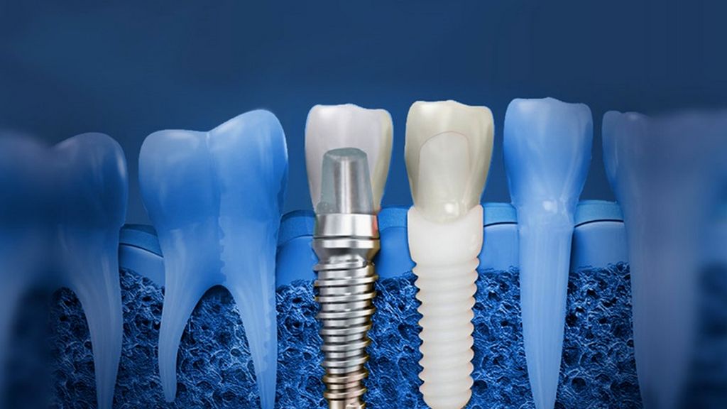 Dental Implants - Bone Level Impression Transfer Parts