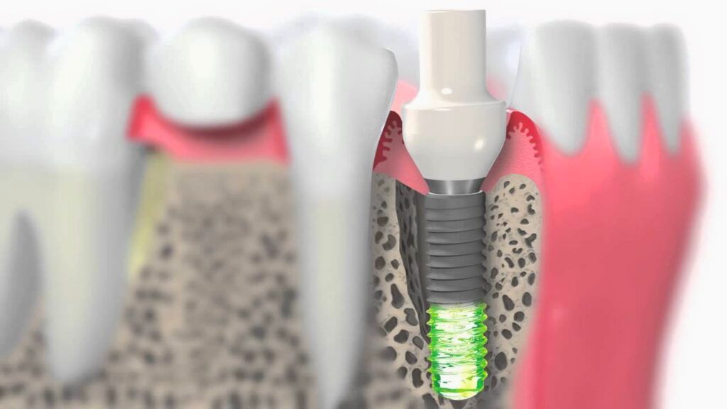 Tissue Level - Analog Implant