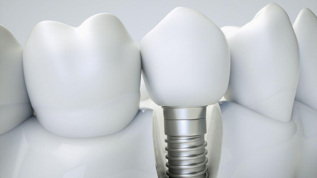 Tissue Level - Bridge Type Coping with Screw Retainer