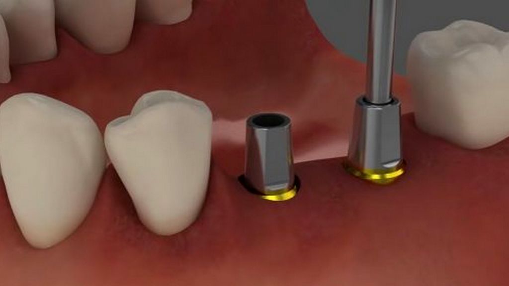 Straight Anatomical Abutment