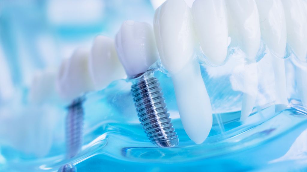 Bone Level - Precision Retained Abutment Analog