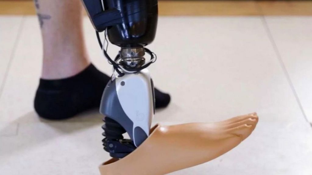 Microprocessor Knee Jointed Above Knee Prosthesis