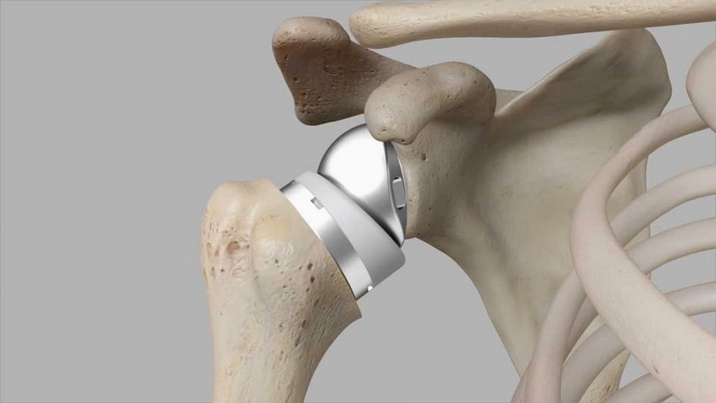 Prótesis de desarticulación de hombro