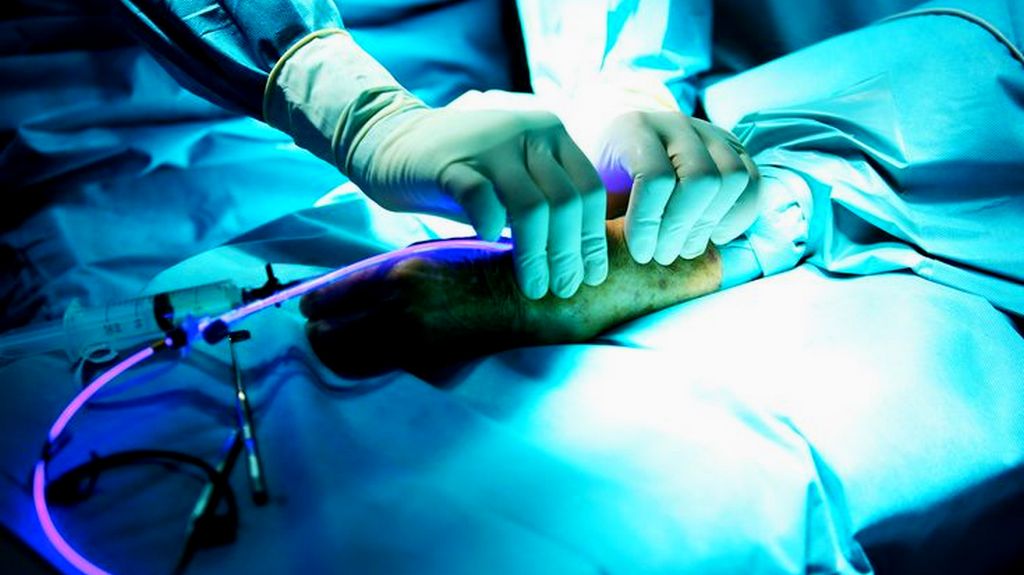 정형외과 - Steinman Pin