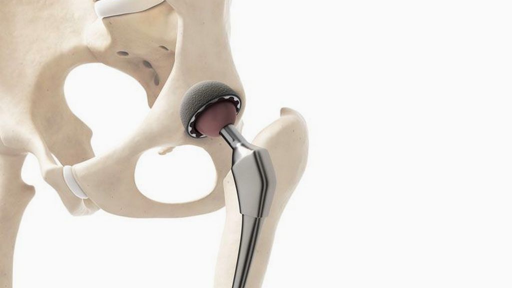 Modular Hip Disarticulation Prosthesis With Polycentric Hip Joint