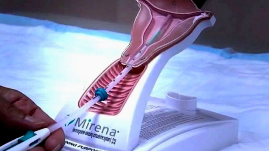 Dispositivos intrauterinos que liberam progesterona