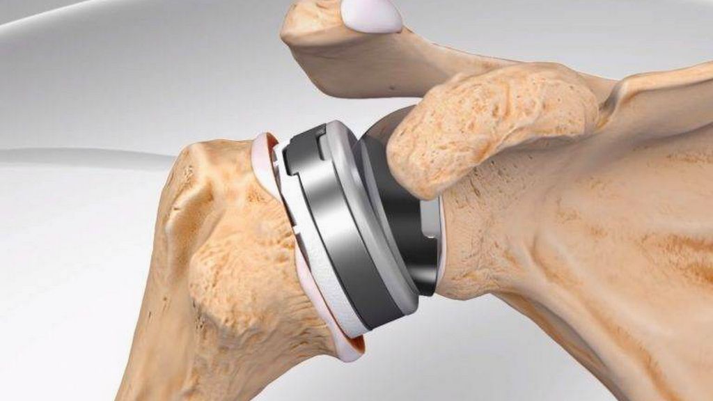 Prótesis de hombro invertidas